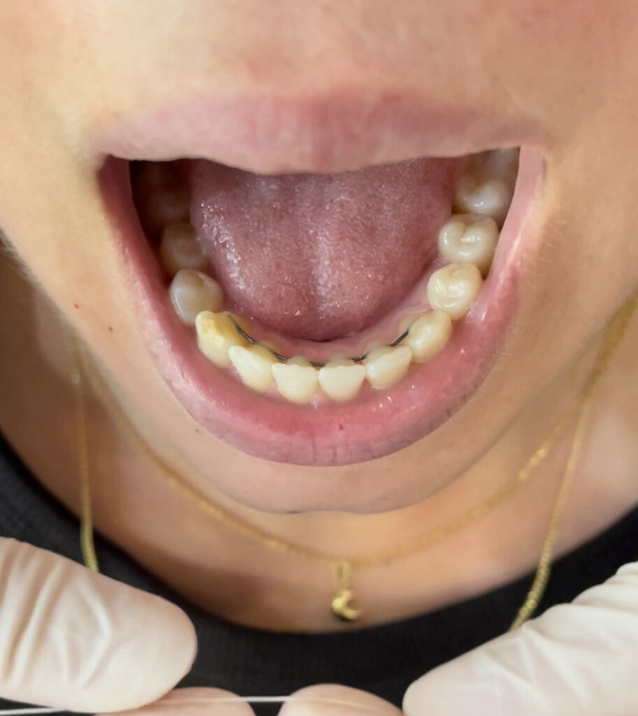 Indicaciones para el cuidado de los retenedores